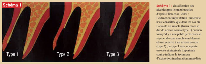 À propos de l'implant OsseoSpeed™ TX Profile d'Astra Tech